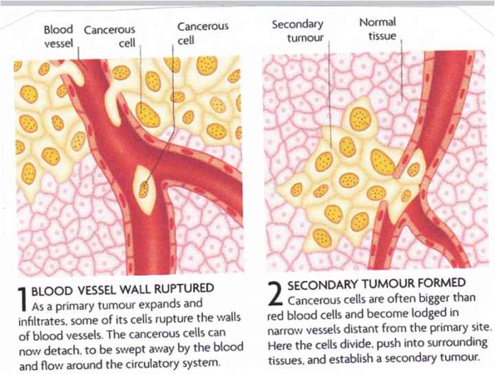Figure 7 How Cancer Spreads Within The Human Body Oxygen Gives Life Figure 7 How Cancer Spreads Within The Human Body Oxygen Gives Life