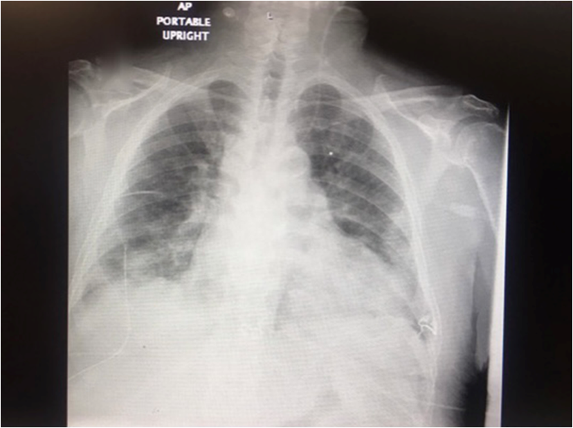 Figure 1 CXR Findings On Admission Showing Ground Glass Opacification