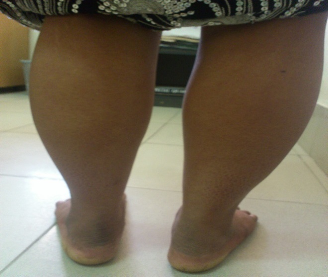Hoffmann s Syndrome A Presenting Manifestation Of Hypothyroidism Hoffmann s Syndrome A Presenting Manifestation Of Hypothyroidism