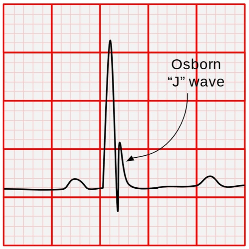 Figure 2 Depiction Of Osborn J Waves On Electrocardiogram Complete