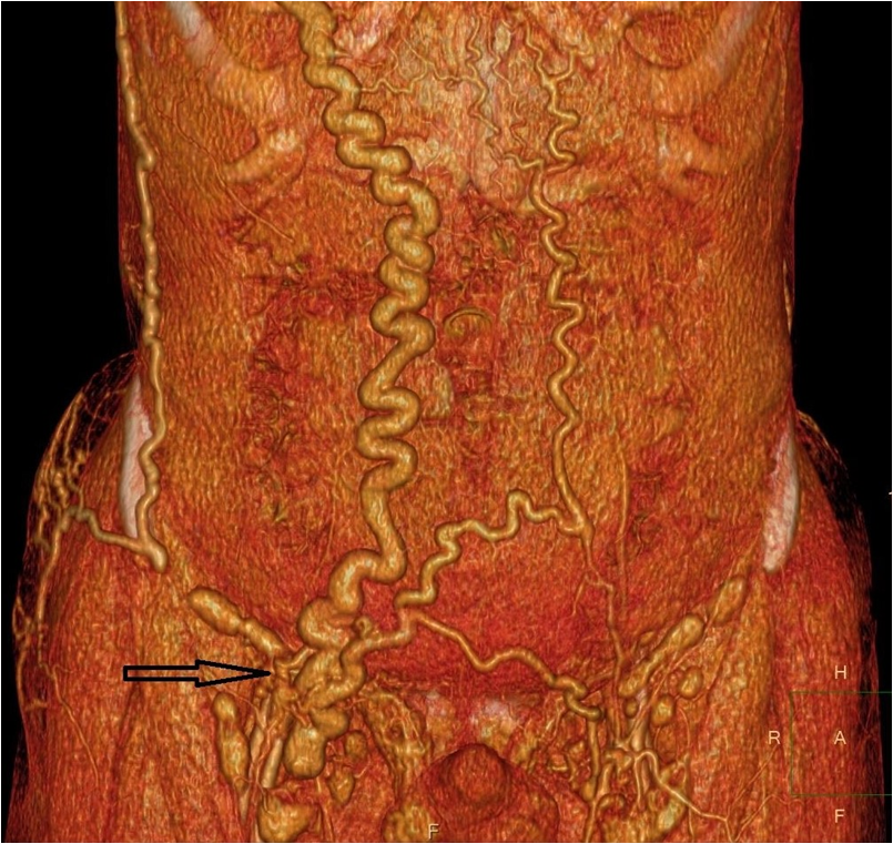 Figure 1. Two-dimensional CT venography scan showing multiple dialated ...