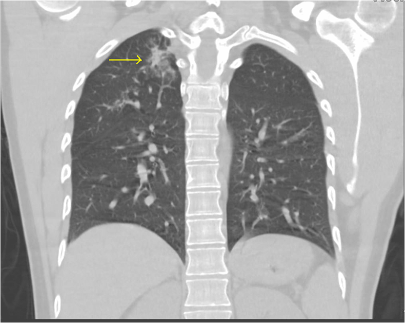 Figure 2. CT Chest: Right apical reticulonodular consolidations. May ...