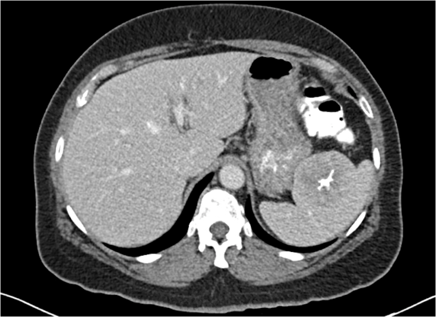 Figure 3. CT scan of splenic mass - Portal 4 minutes phase : Robotic ...