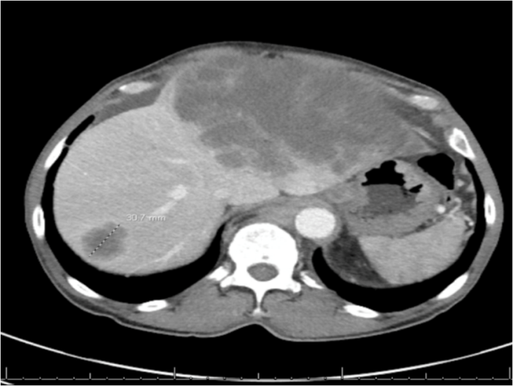 Figure 1. Multiple ill-defined lesions within the right & left hepatic ...