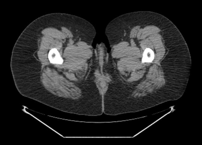 Figure 2. (A) CT showing mass in vagina : Vaginal Small Cell ...
