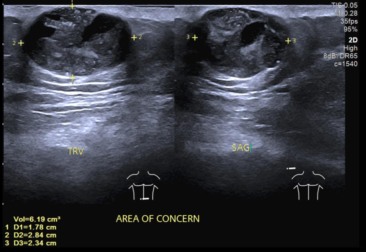 Figure 1. 1.78x2.84x2.34 cm y ultrasound : A Rare Case of Lower Back ...