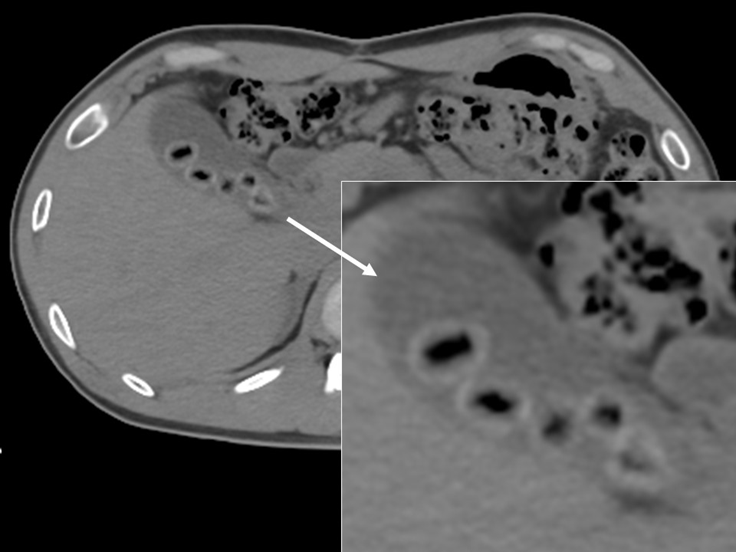Figure 1. Abdominal computed tomographic image (CT) : Gas in Gallstones ...