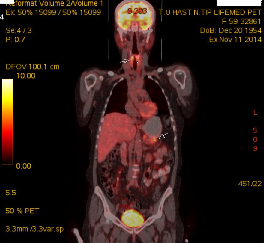 Figure 3. 18F-FDG PET/CT images; globally increased FDG uptake at the ...