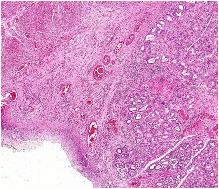 C. Duodenal Biopsy showing villous atrophy : Extreme Thrombocytosis: A ...