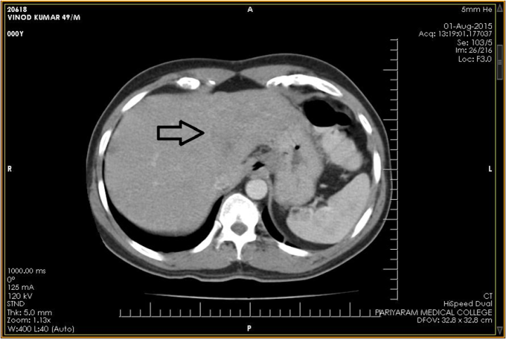 Figure 4. CECT showing non enhancement by mass lesions in the liver : A ...