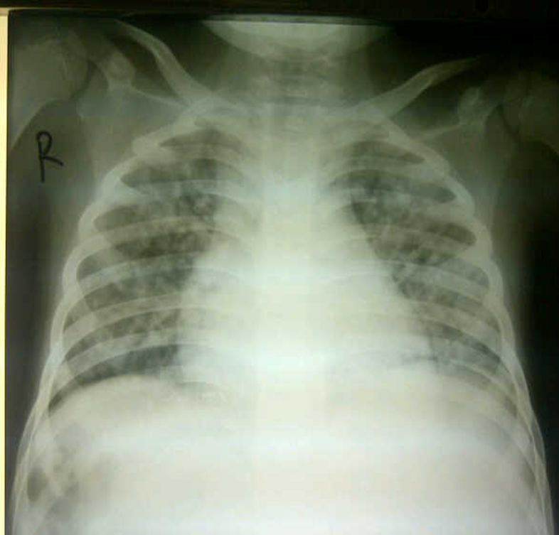 X Ray Of Pneumonia In Children
