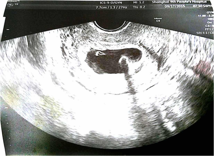Figure 1. Picture from the ultrasound showing the IUD in place. (45 ...