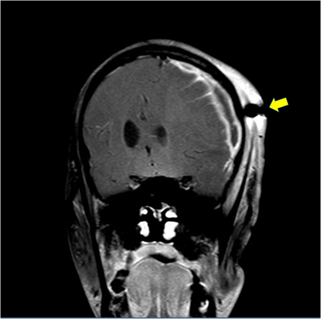 Figure 5. T1-weighted sequence MRI scan of the head with intravenous ...