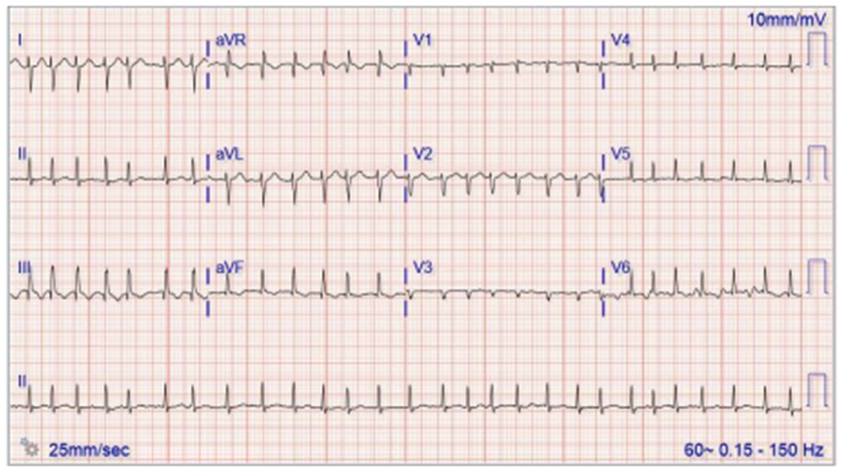 Figure 1. EKG showing AFib with RVR : T3 Thyrotoxicosis Induced Dilated ...