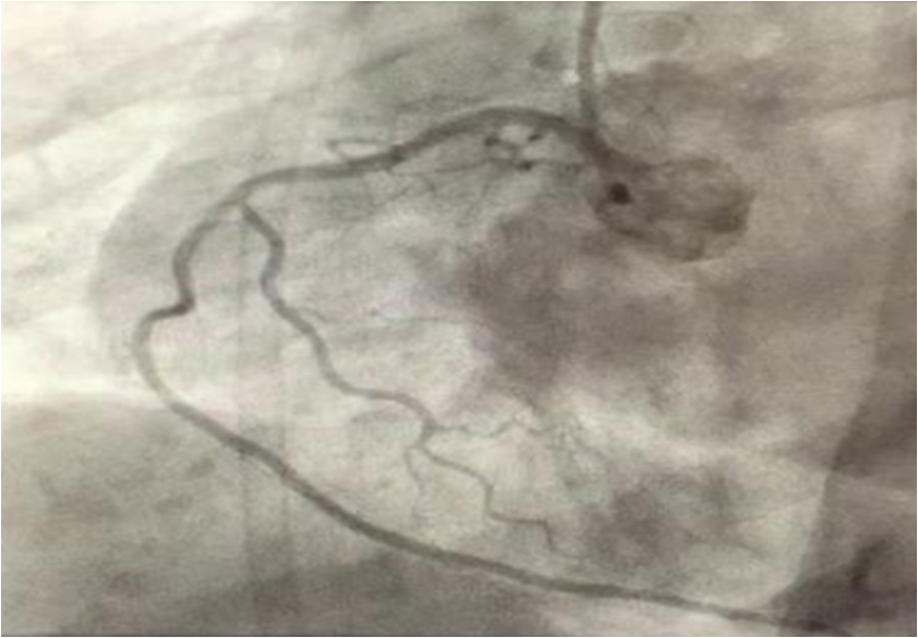 Figure 6. Coronary angiography showing normal right coronary artery : A ...