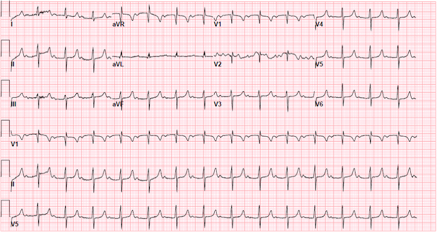 Figure 9. ECG at three-weeks follow-up, demonstrating resolution of ST ...