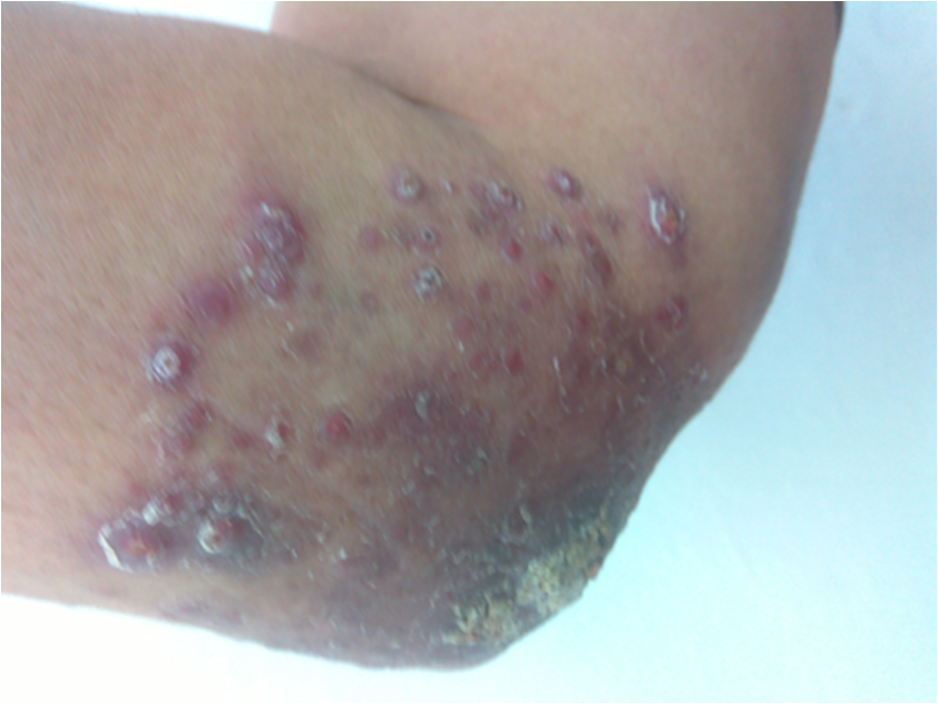 Figure 1. Right elbow in flexion: multiple papules and pseudo-vesicles ...