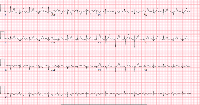 Figure 2. EKG showing sinus tachycardia and inferior infarct : Thrombus ...