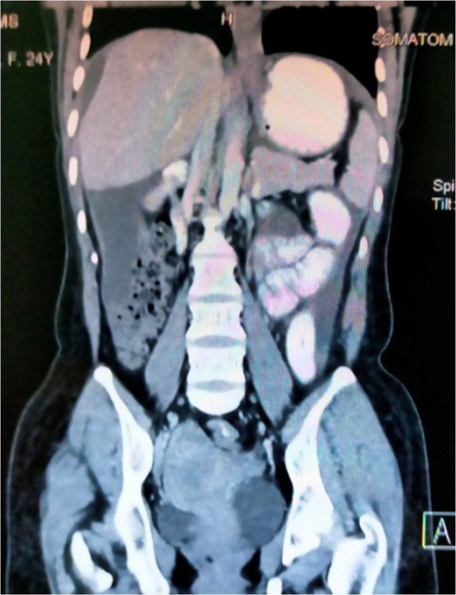 Abdominal Ct Coronal View
