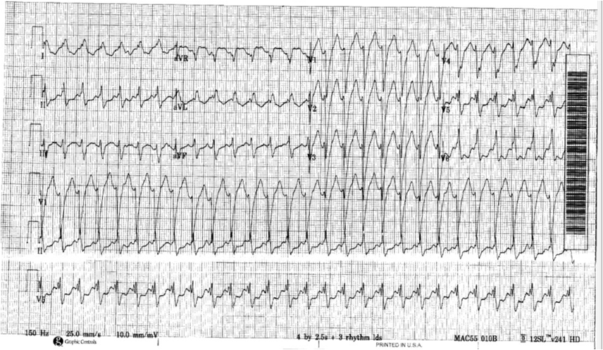Figure 1. Initial ECG Noting Sustained Wide-Complex MVT Upon ...