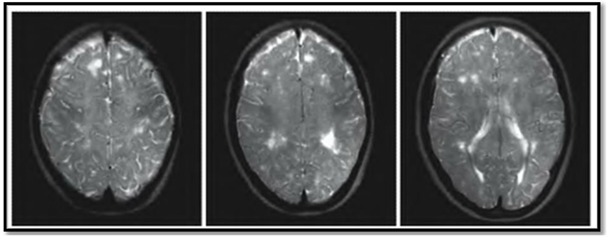 Figure 5. Galactosemia girl of 14 years old with galactosemia type 1 ...