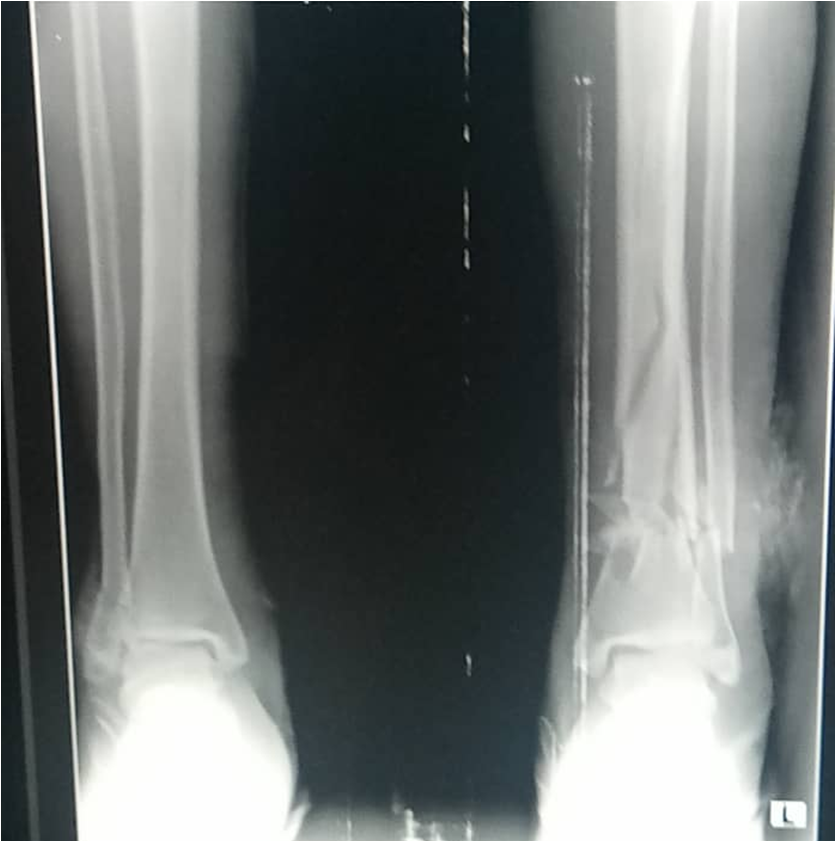 Figure 1. Plain radiograph of right ankle fracture and comminuted ...