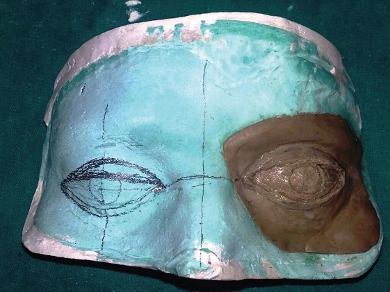 Figure 6. Clay pattern of sculpted on the facial moulage : Patient ...