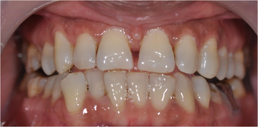 Figure 2. Envelope of function Adequate : Implant for Posterior Molar ...