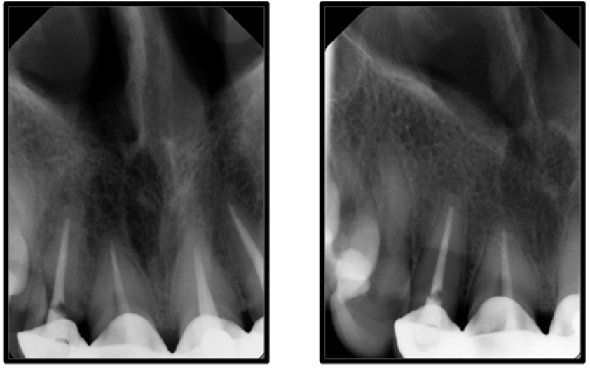 Figure 5. The periapical radiographs show the tooth 12 after 24 months ...